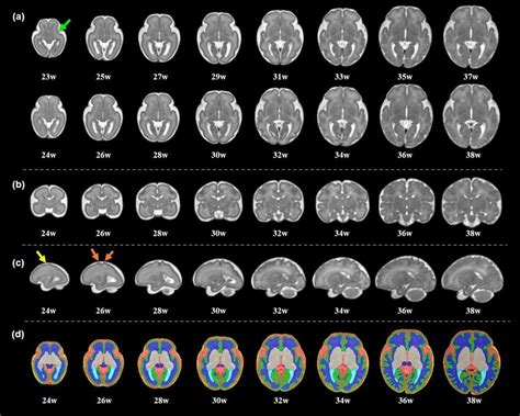 Spatiotemporal Structural Atlas Of Fetal Brains Based On Chinese Download Scientific Diagram