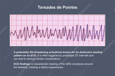 Ecg Displaying Torsades De Pointes Rhythm Illustration Stock Image F042 5173 Science