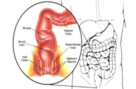 Ulcerative Proctitis