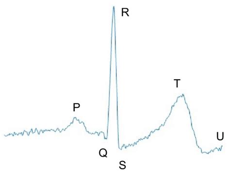 Fiducial Points Highlighted Plotted Out Over One Ecg Signal From Cybhi