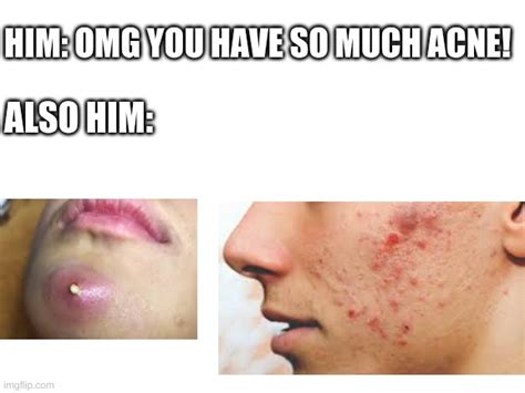 Funny Acne Memes