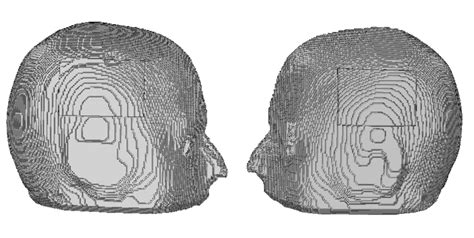 Stimulating Electrodes For Auditory Cortex Stimulation The Anode Left