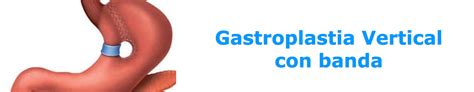 Gastroplastia Com Faixa Vertical