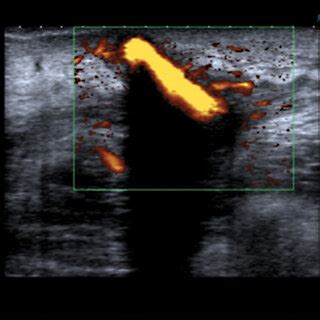 Pdf The Human Botfly “bubbling Sign” Ultrasound Features Of