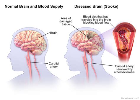 Normal Brain Compared With Stroke
