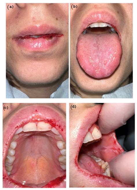 Erythema Multiforme Major Mouth