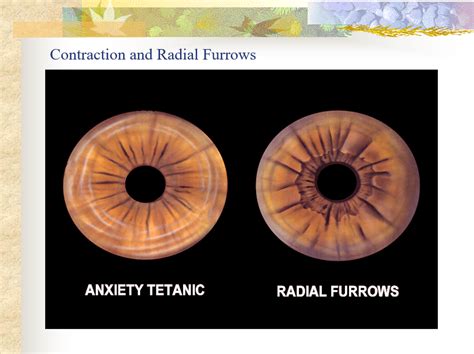 Contraction Furrows Sclera Signs And Syndromes ~ Cd Rom Ppp Ellen