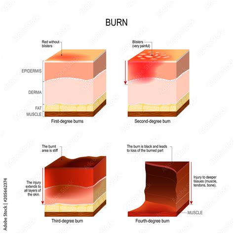 Skin Burn Four Degrees Of Burns Stock Vector Adobe Stock