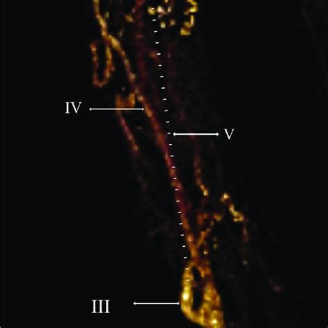 Distal Revascularization Interval Ligation Dril Download