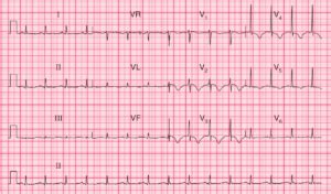 ECG Case 111 Marked Prolongation Of The QT Interval Long QT Syndrome Manual Of Medicine