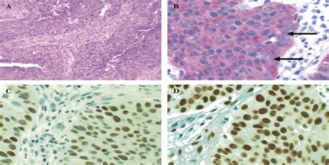 Abnormalities Of The Rb1 Pathway In Ovarian Serous Papillary