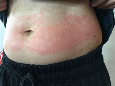 Understanding Postpartum Skin Rashes Causes And Remedies