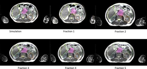 An Example Of Clinical Mri Linac Images Utilized For Inter Fractional