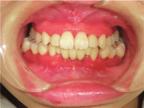 Intraoral View Showing Redness And Swelling Of The Marginal And