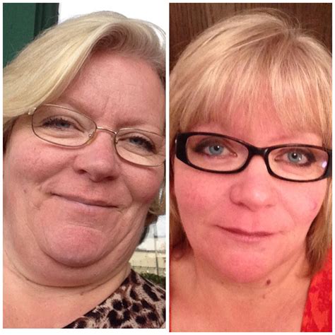 Armour Thyroid Before And After