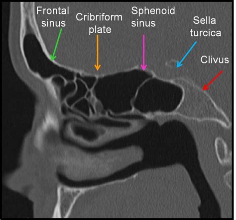 Planum Sphenoidale Anatomy