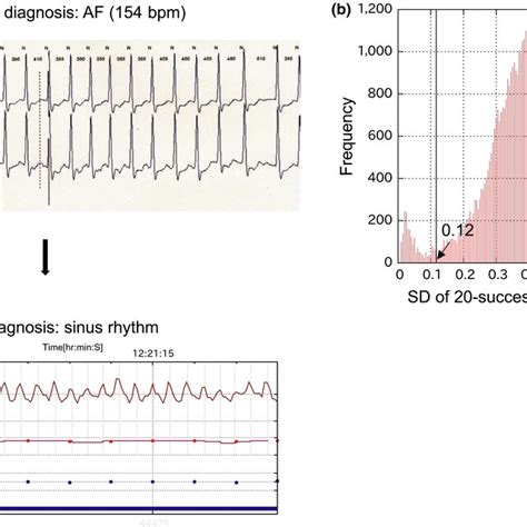 A Example Of Recording Af With A High Ventricular Response The Upper Download Scientific