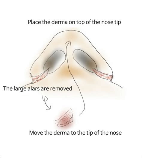 Dr Lee Breast Augmentation Korea Rhinoplasty Korea Blunt Nose Tip Correction