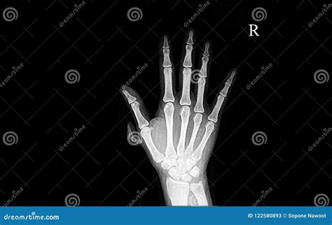 Polydactyly On Human Rare Abnormal Characteristic Causes By Chromosome