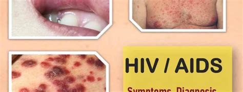 Hiv Symptoms Hiv Symptoms Photos And Images Shutterstock