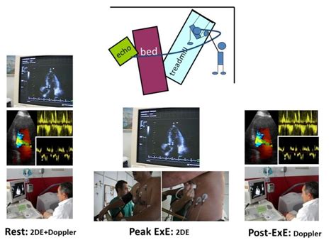 Exercise Echo A Diastolic And Systolic Function Evaluation Test For Patients With Dyspnea