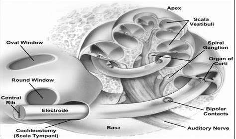 Drawing Of Implanted Cochlea With Electrode Download Scientific Diagram