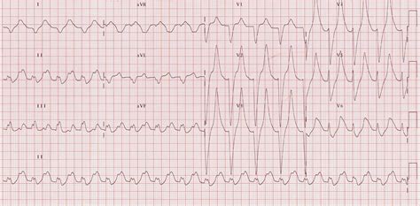 Lvad Case Em Sim Cases