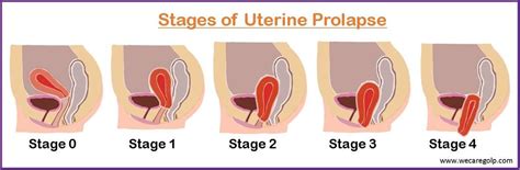 Understanding Uterine Prolapse Causes Symptoms And Treatment