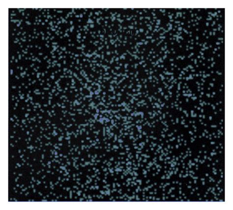 A B The Patients Iodine Thyroid Scan With No Uptake By The Thyroid