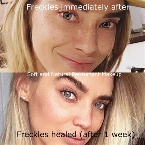 Freckles Beauty Marks — Soft And Natural Aesthetics