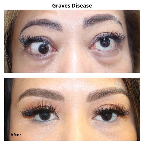 Before And After Thyroid Eye Disease
