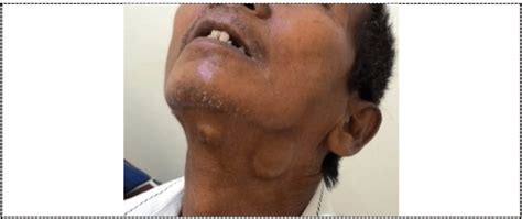 Submental Lymph Node