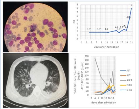 Upper Left Panel Bone Marrow Aspiration Myeloblasts In High Power