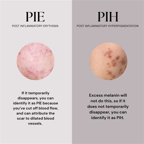 Sophia Caruso On Instagram Post Inflammatory Erythema Pie And Post