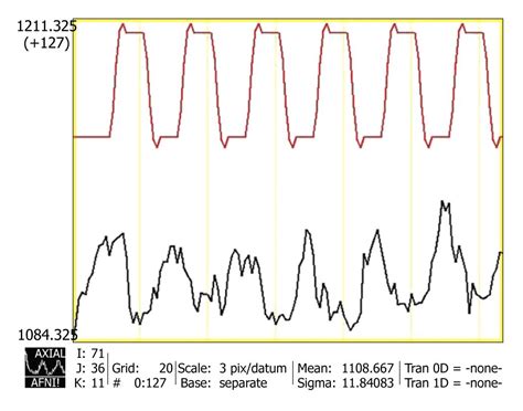 Cerebrovascular Reactivity Mapping For Brain Tumor Presurgical Planning
