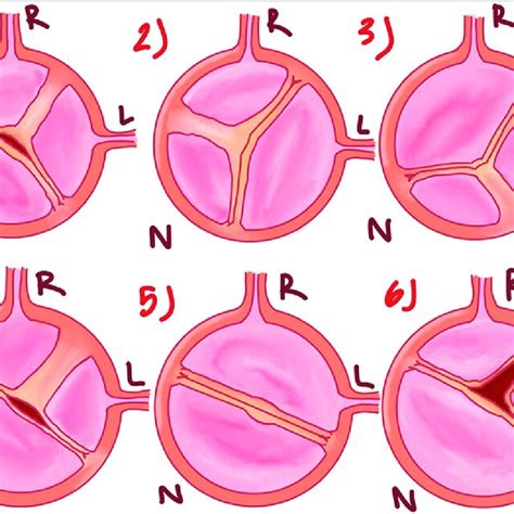 Bav Morphology 1 Type 1 Bav With Complete Raphe And Asymmetrical As Download Scientific