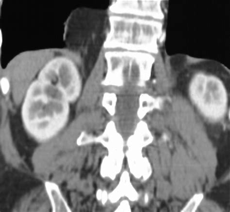 Fat Containing Lesions Of The Chestradiographics