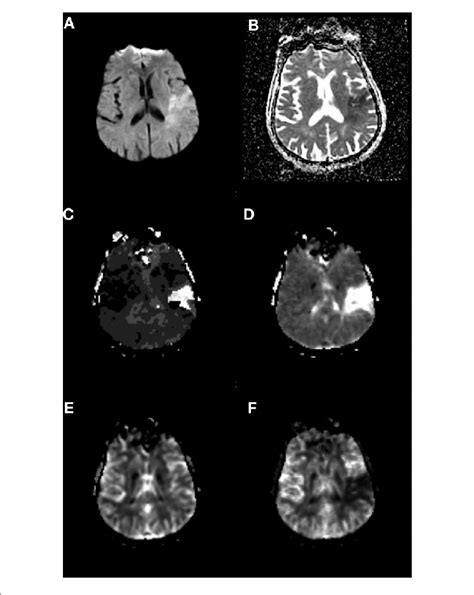 Perfusion Diffusion Mismatch To Identify Salvageable Tissue A Download Scientific Diagram