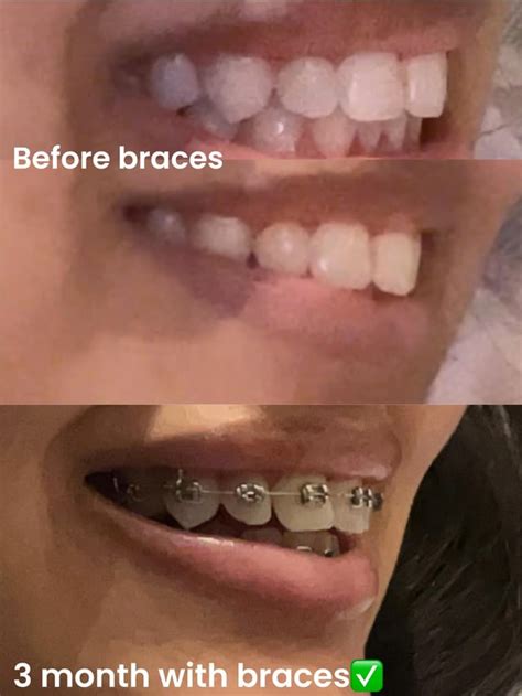 In The Ugly Phase🌞 Rbraces