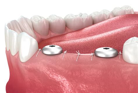 치은은 임플란트 전 의학적으로 정확한 3d 일러스트레이션 치은염에 대한 스톡 사진 및 기타 이미지 치은염 건강관리와 의술 도예 Istock