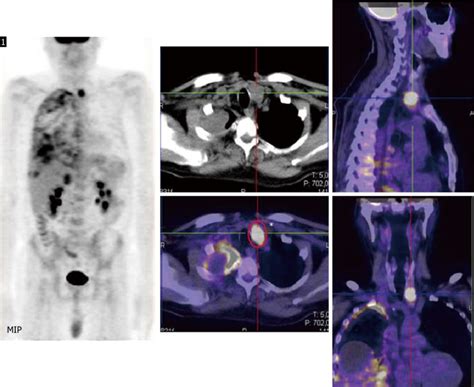 Staging Right At Maximum Intensity Projection The Parathyroid And