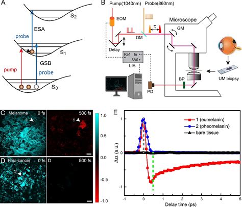 Frontiers Label Free Delineation Of Human Uveal Melanoma Infiltration