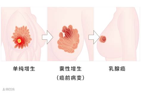 乳腺癌 医学插画