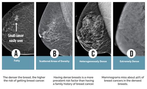 Home Dense Breasts Canada Your Breast Health Matters