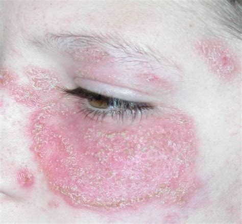 Eczema Ringworm On Eyelid At James Jain Blog