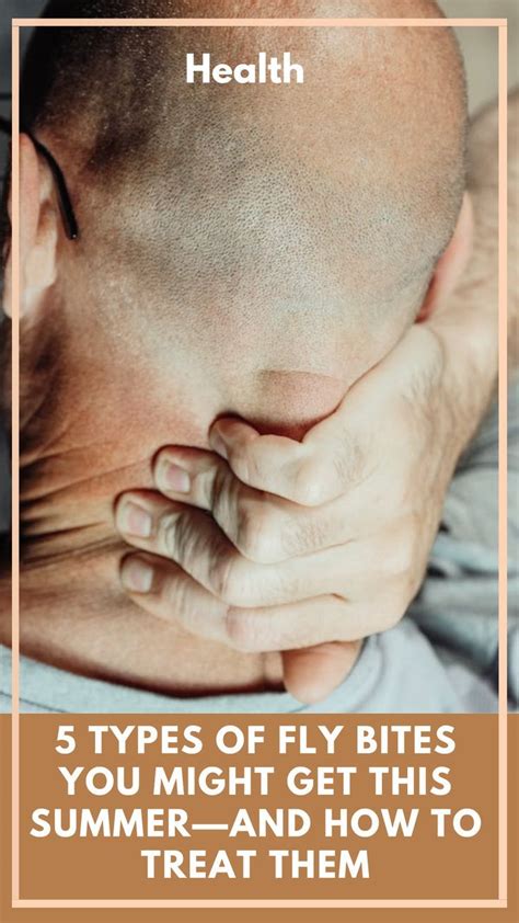 5 Types Of Fly Bites You Might Get — And How To Treat Them Fly Bites