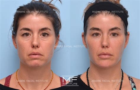 Drooping Brow Before And After Pictures Case 1166 San Francisco Ca