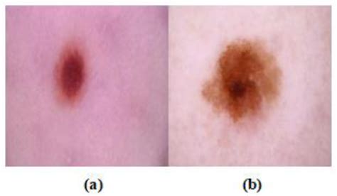 Examples Of A Benign Image B Malignant Melanoma Image Download