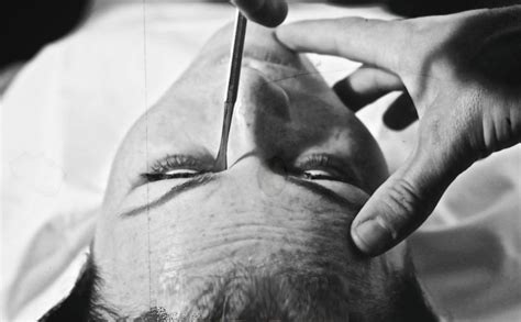 The Horror Of Lobotomy The Ice Pick Cure Patients Were Desperate To
