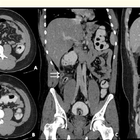 Figure C Intraoperative Finding Of Stump Appendicitis Download